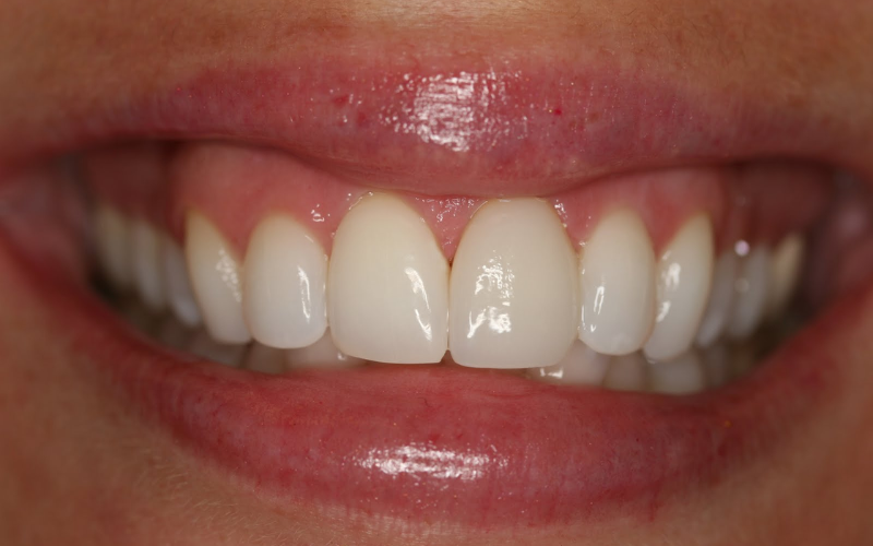 Porcelain Crowns for Front Teeth: A Complete Guide